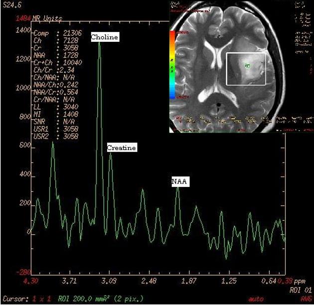 MRI ספקטרוסקופיה - MRS - MRI המדריך המלא